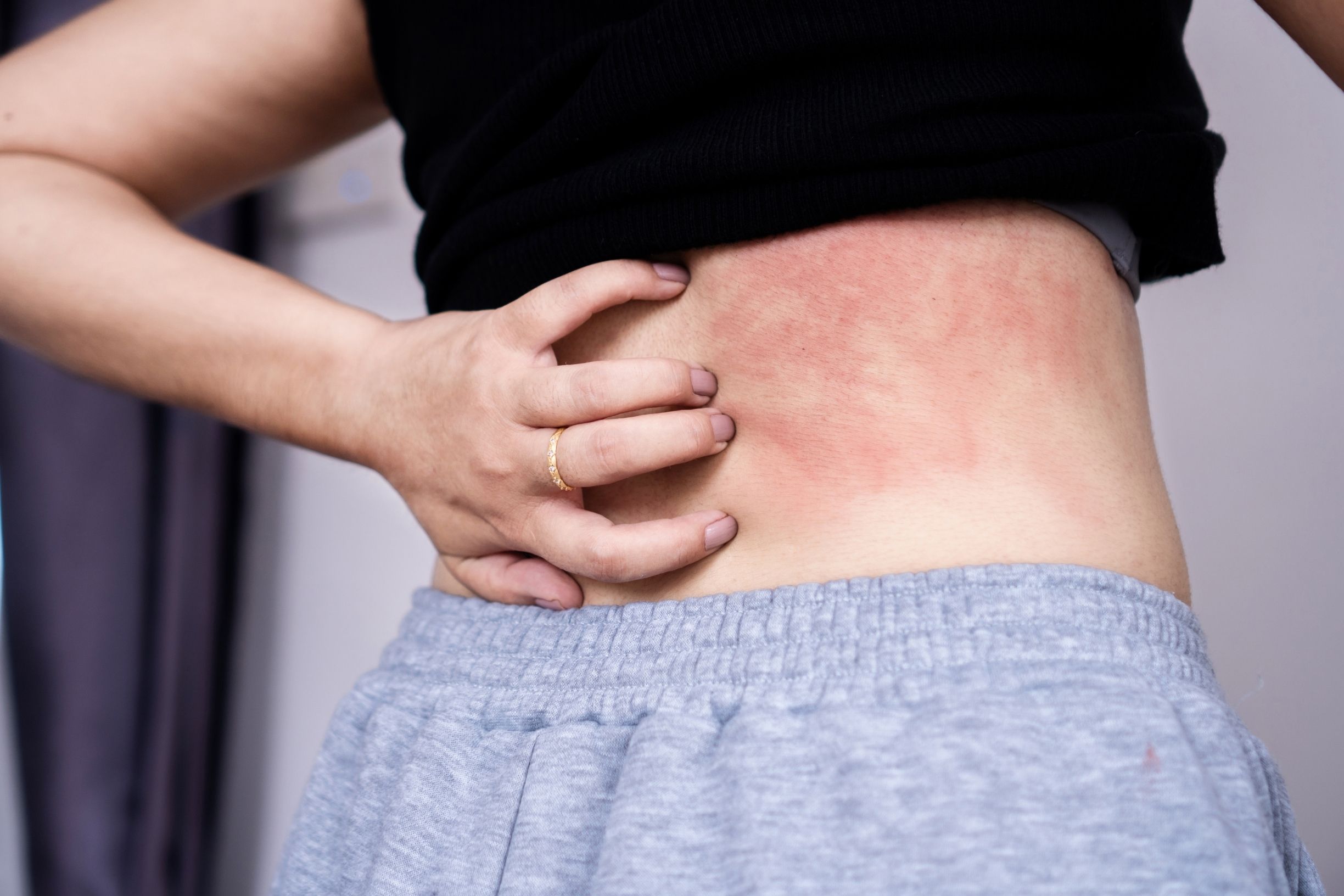 Don’t Let a Rash Ruin Your Day - Urgent Care Rash Treatment in Falls ...